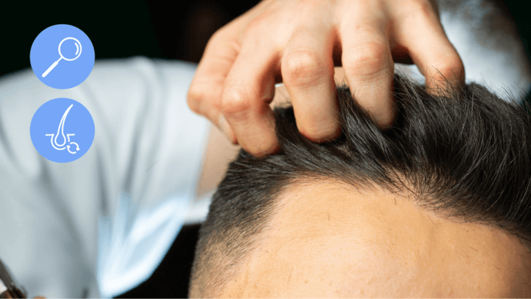 6 Accurate Signs of Balding - how to tell if you’re going bald
