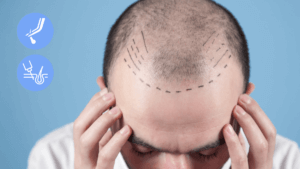 FUE Hair Transplant - Procedure, Risks, Cost, and Everything Else
