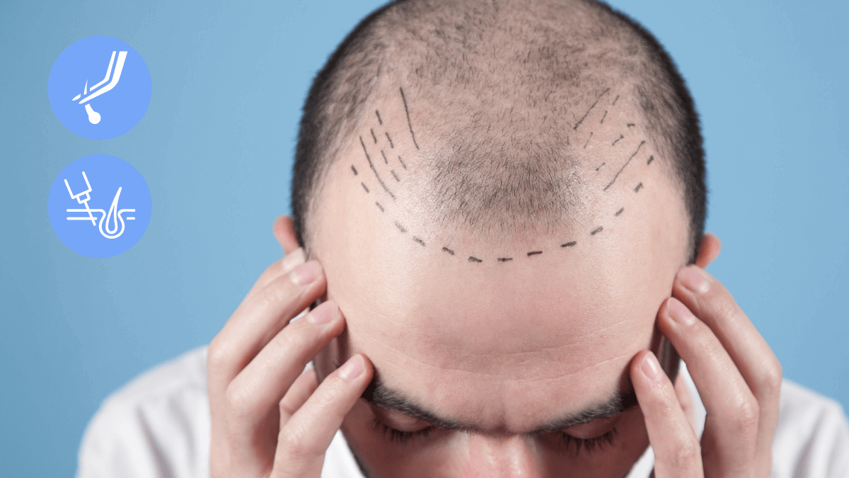 Fue Hair Transplant Procedure Risks Cost And Everything Else