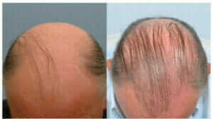 3 Hair Transplant Failures + Why and How Often do they happen?