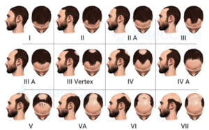 6 Accurate Signs of Balding - How Can I Know if I’m Going Bald?