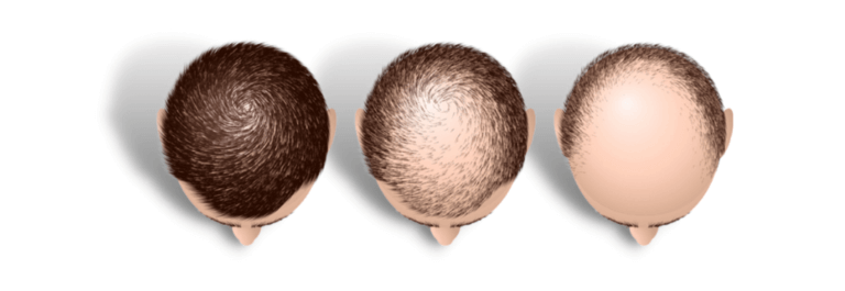 Male Pattern Baldness: Identification, Causes,Treatment, and Patterns