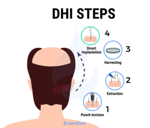 DHI vs. FUE - an in-depth comparison of both methods