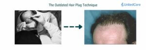 What are Hair Plugs and Are They Still Used in 2022?