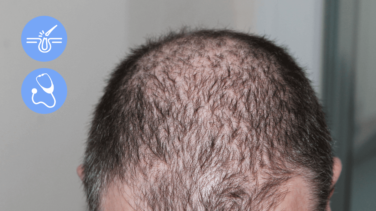Is There a Cure for Baldness? - explained by a dermatologist - UnitedCare