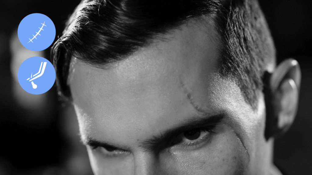 Hair Transplant Scars - what’s permanent and what will heal (explained ...