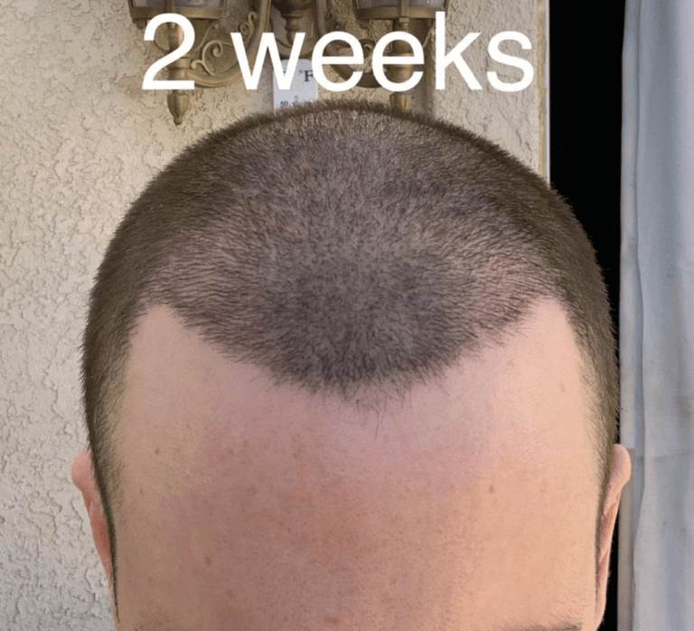 Before And After Photos Of Hair Transplant Surgeries What Success And