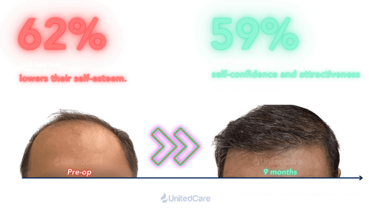 Calculate Grafts + Find out the Worldwide Costs in 30 Seconds