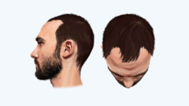 Male Pattern Baldness: Identification, Causes,Treatment, and Patterns