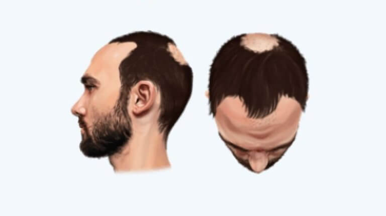 Male Pattern Baldness: Identification, Causes,Treatment, and Patterns