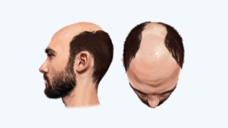 Male Pattern Baldness: Identification, Causes,Treatment, and Patterns