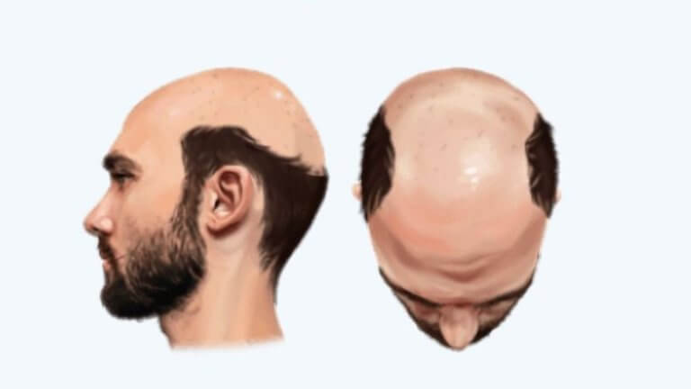 Male Pattern Baldness: Identification, Causes,Treatment, and Patterns