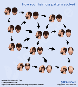 Male Pattern Baldness: Identification, Causes,Treatment, and Patterns