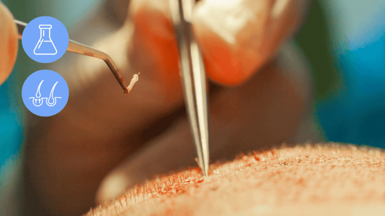 Hair Transplant Safety - what are the risks and how to avoid them ...