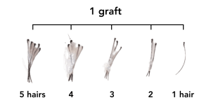 Calculate Grafts + Find out the Worldwide Costs in 30 Seconds