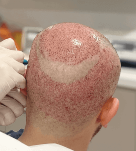 Trypophobie bei Haartransplantationen: Die Angst vor Löchern in der ...