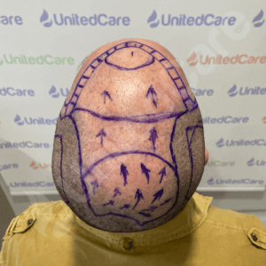 23 Finasteride Alternatives That Are Clinically-Proven