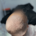 What Is the Best Hair Transplant Method? DHI, FUE and others compared