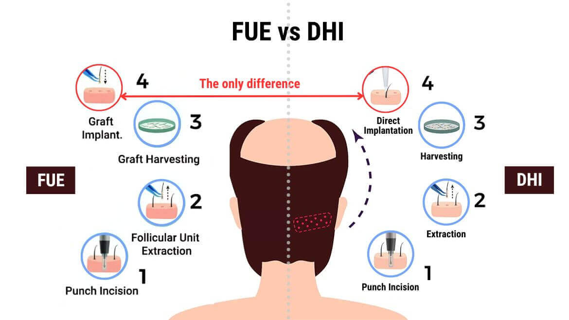 DHI vs FUE: Which one is the best for you?